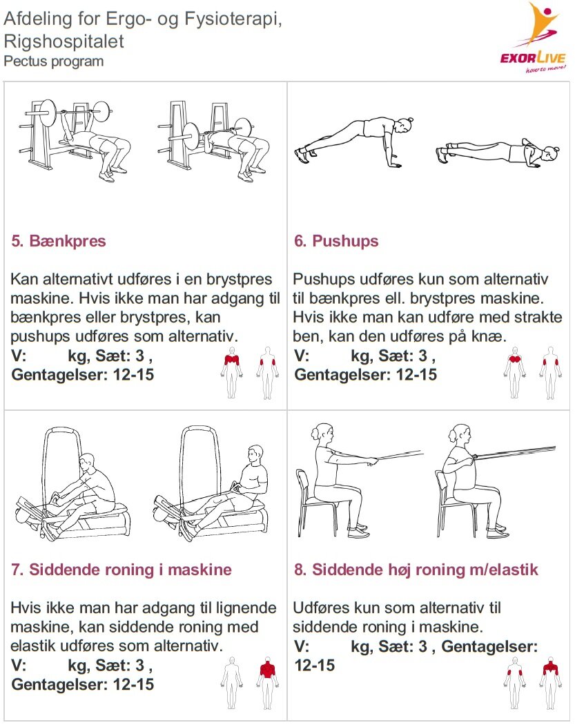 Tragtbryst (pectus excavatum)